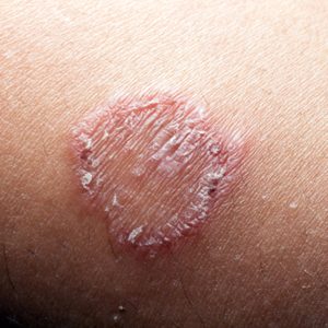 Skin Infections: What You Should Know - The Ghanaian Chronicle